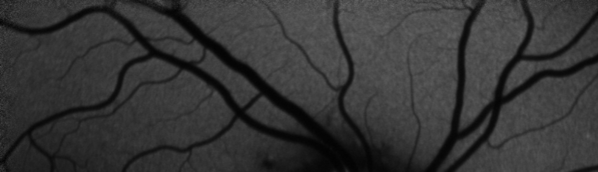 Peripapillary retinal nerve fiber layer thickness corresponds to drusen ...